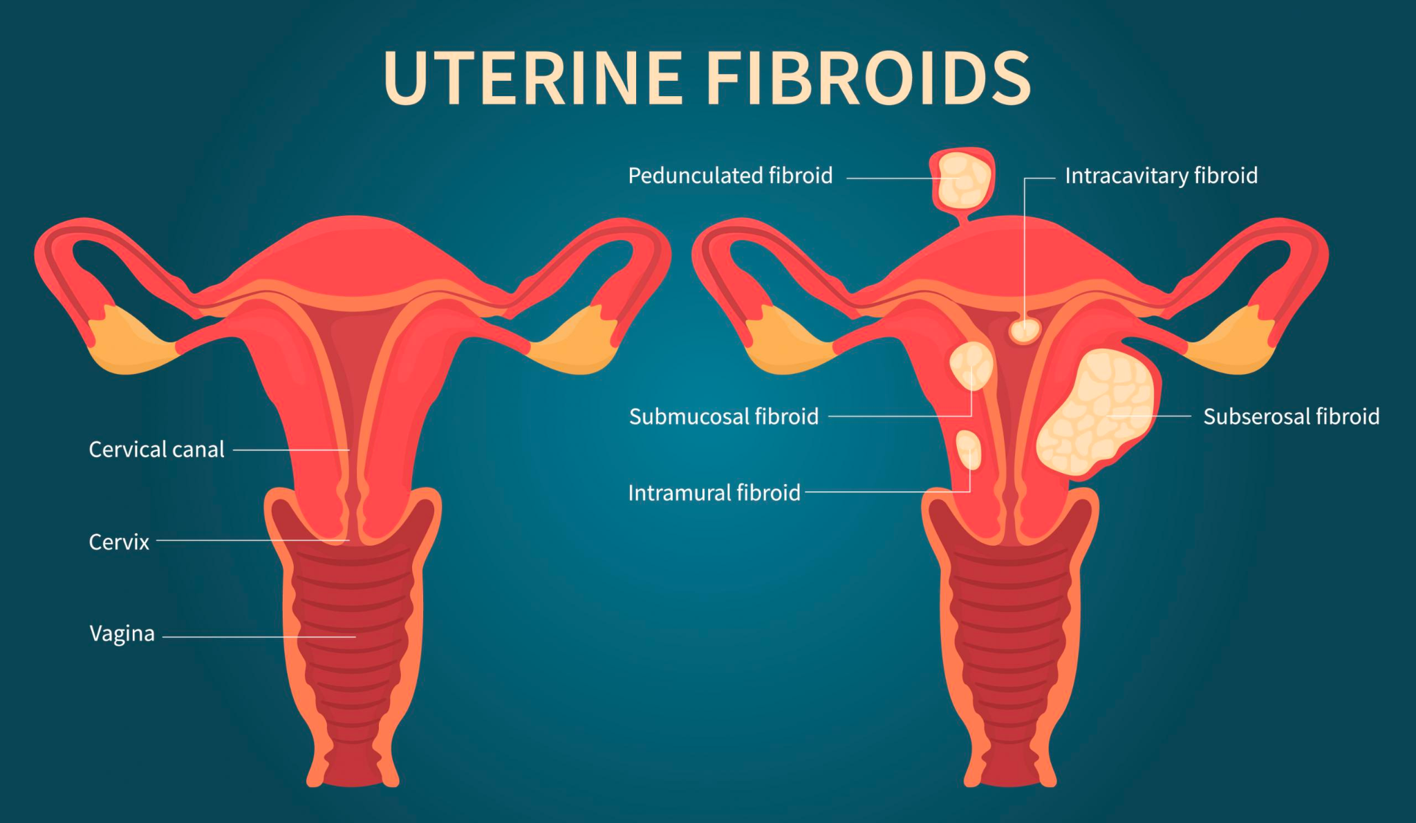 Thyroids and Fibroids: How are these two diseases connected? - Fibroid ...