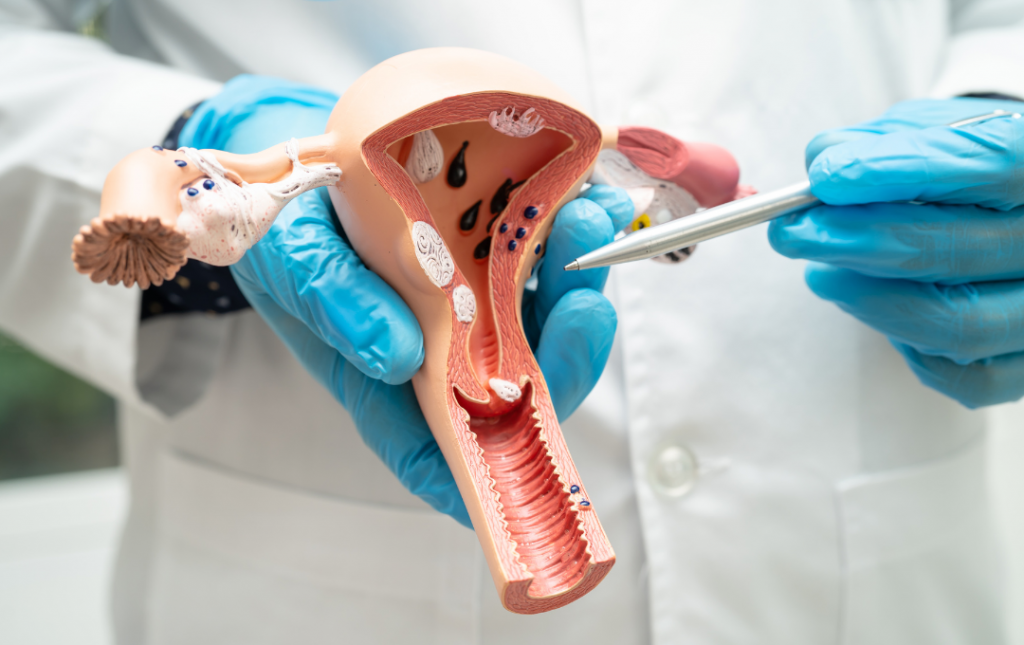 Thyroids And Fibroids How Are These Two Diseases Connected Fibroid Fighters