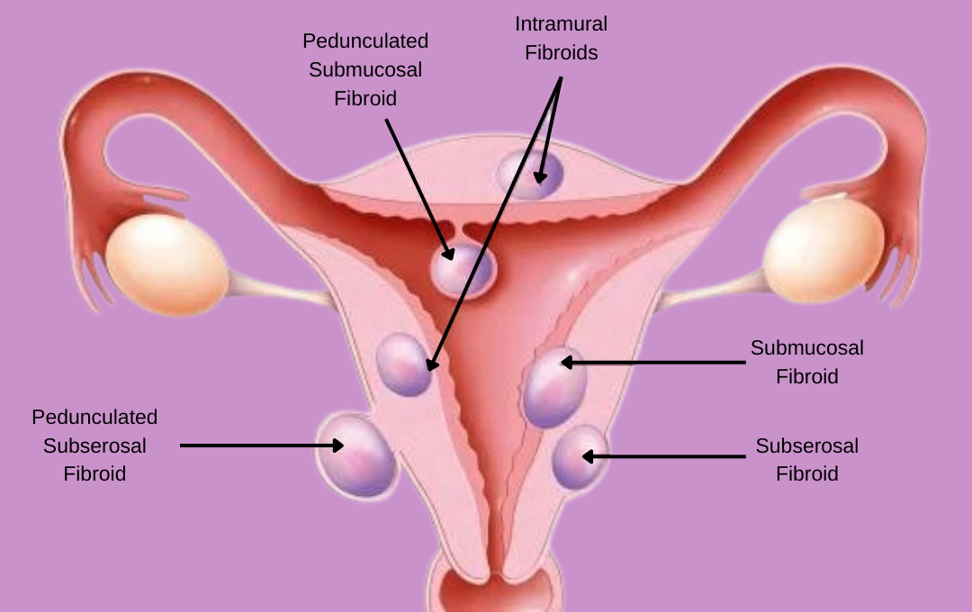 What Are The Different Kinds Of Fibroids? | Fibroid Fighters